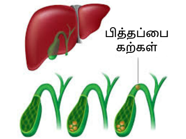 பித்தப்பை கற்கள் இருந்தால் மற்றொரு அபாயமும் உண்டாகும்! அது என்ன? | Gall ...