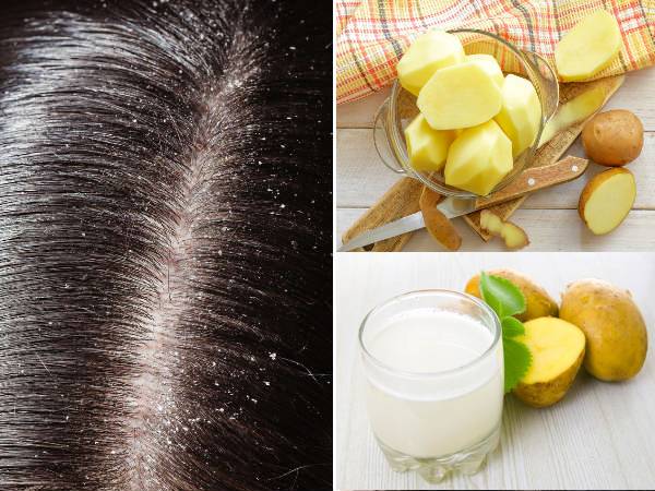 Benefits Of Potato Juice For Hair : பொடுகு தொல்லையில் இருந்து நிரந்தர ...