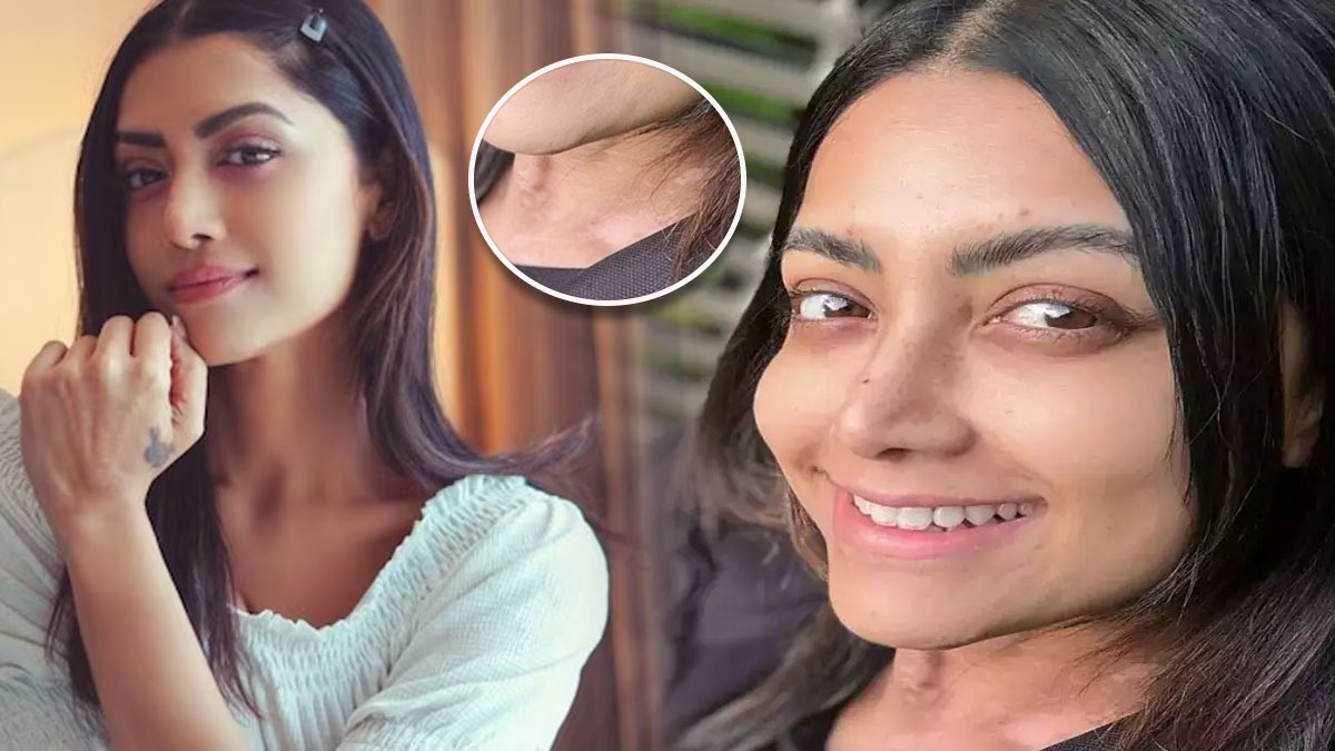 புற்றுநோயில் இருந்து மீண்டு வெண்படை நோயின் பிடியில் சிக்கிய நடிகை மம்தா மோகன்தாஸ்! | Mamta ...