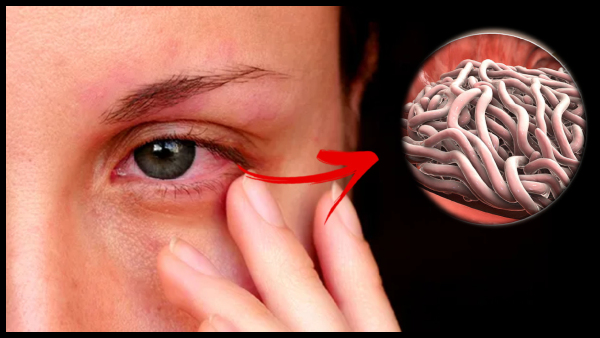 சீனாவில் ஒரு பெண்ணின் கண்ணில் இருந்து 60 உயிருள்ள புழுக்களை அகற்றிய ...